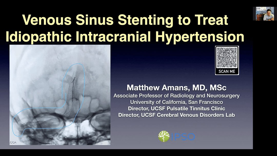 Venous Sinus Stenting to Treat Idiopathic Intracranial Hypertension ...